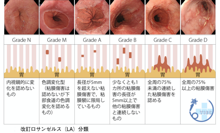 逆流性食道炎の症状・検査・治療｜横浜市神奈川区横浜駅から徒歩3分、内視鏡検査なら横浜ベイクォーター内科・消化器内視鏡クリニック 横浜駅院